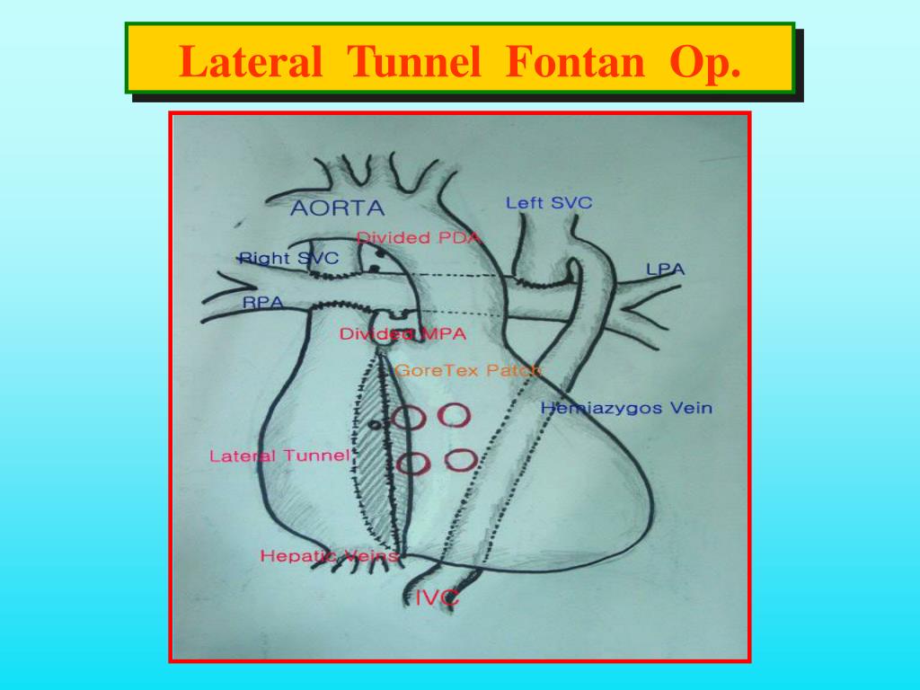 PPT - Repair of Congenital Aortic Valve Disease PowerPoint Presentation ...