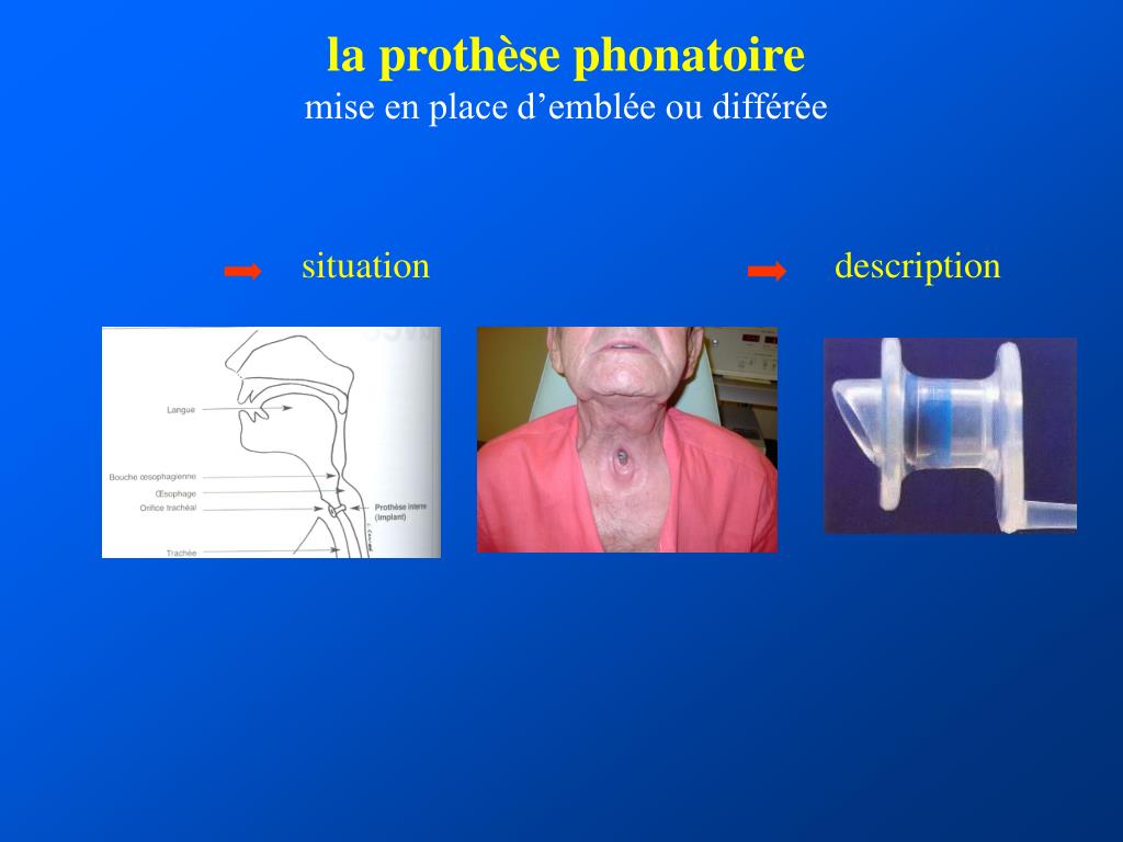 PPT - SOINS INFIRMIERS CHEZ LE PATIENT LARYNGECTOMISE OU PORTEUR D ’UNE ...