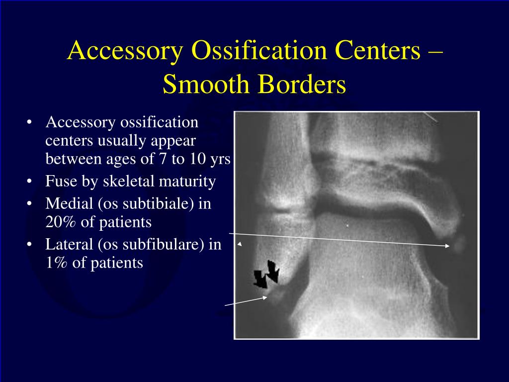 PPT - Pediatric Ankle & Foot Fractures PowerPoint Presentation - ID:3363563