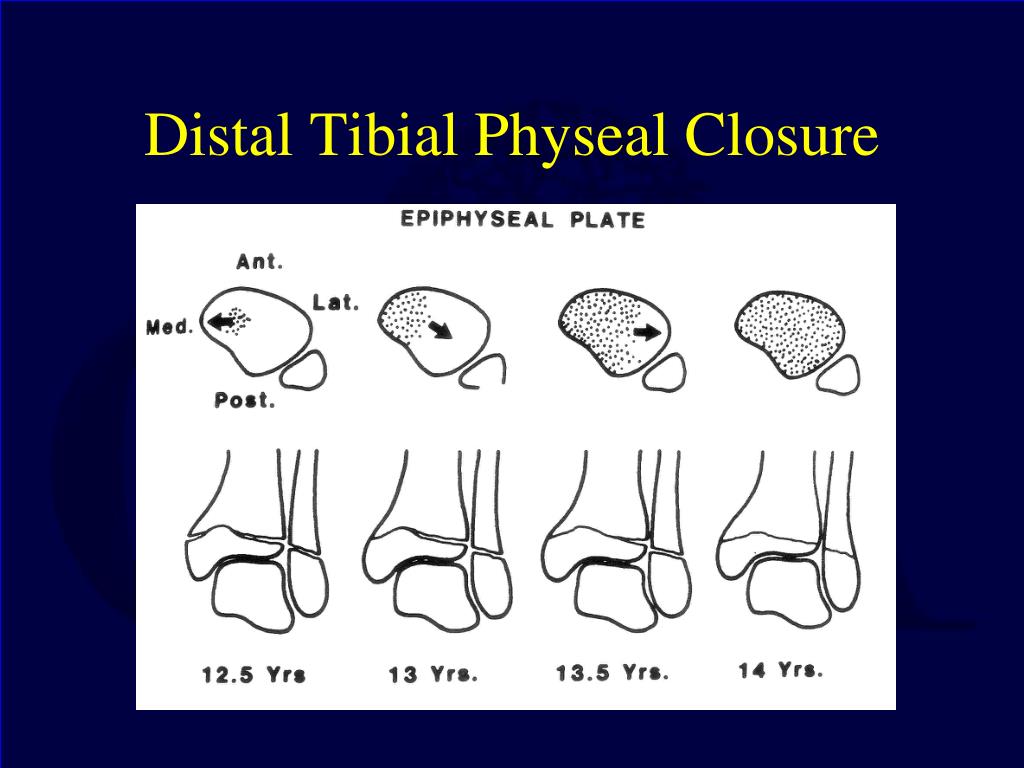 PPT - Pediatric Ankle & Foot Fractures PowerPoint Presentation - ID:3363563