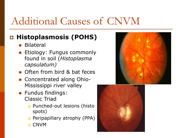 PPT - Common Posterior Pole Disorders PowerPoint Presentation - ID:3364585