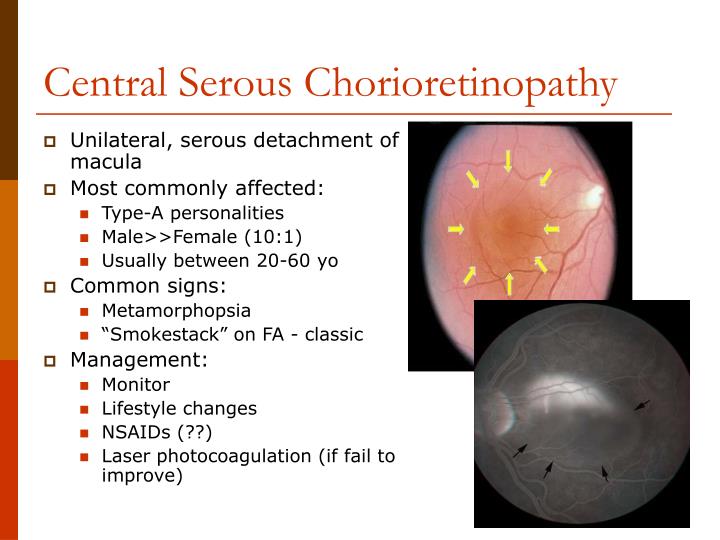 PPT - Common Posterior Pole Disorders PowerPoint Presentation - ID:3364585