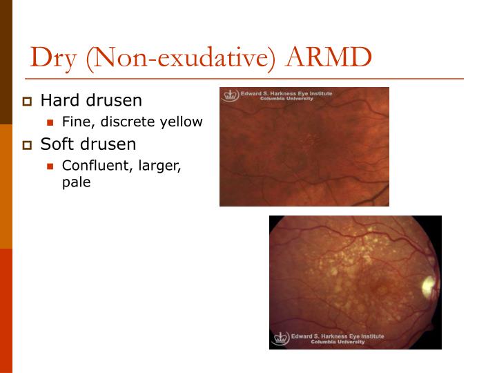 PPT - Common Posterior Pole Disorders PowerPoint Presentation - ID:3364585