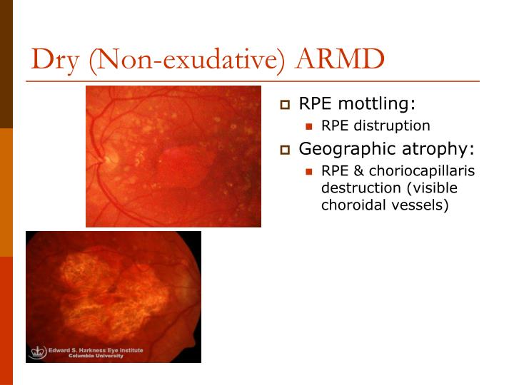 PPT - Common Posterior Pole Disorders PowerPoint Presentation - ID:3364585