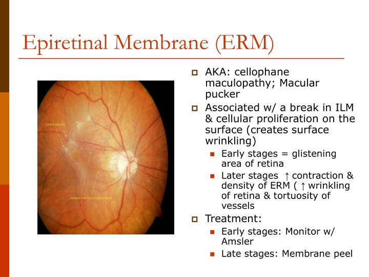 PPT - Common Posterior Pole Disorders PowerPoint Presentation - ID:3364585