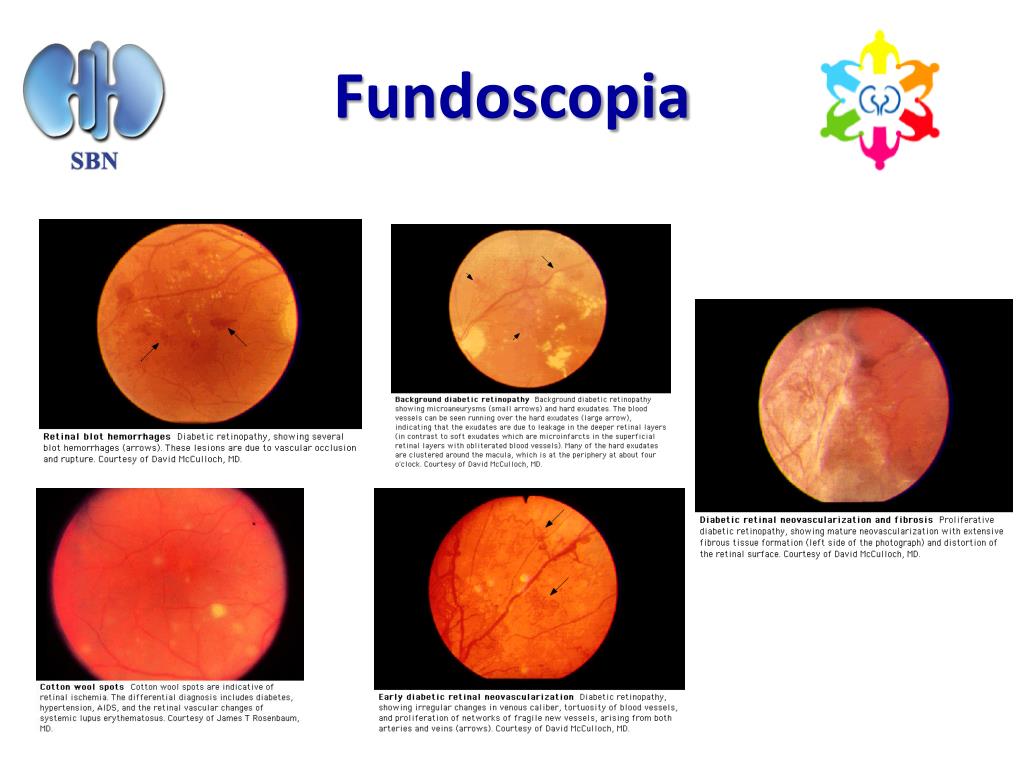 PPT - DIAGNÓSTICO E ESTADIAMENTO DA DOENÇA RENAL CRÔNICA PowerPoint ...