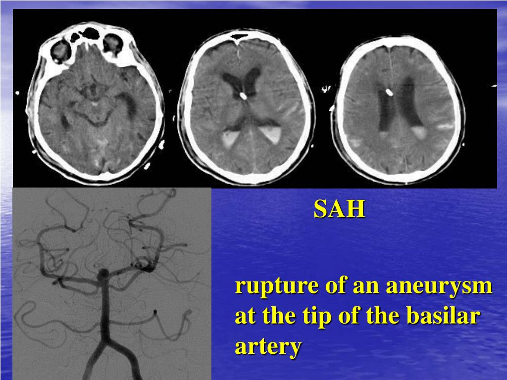 Ppt Subarachnoid Hemorrhage Powerpoint Presentation Free Download