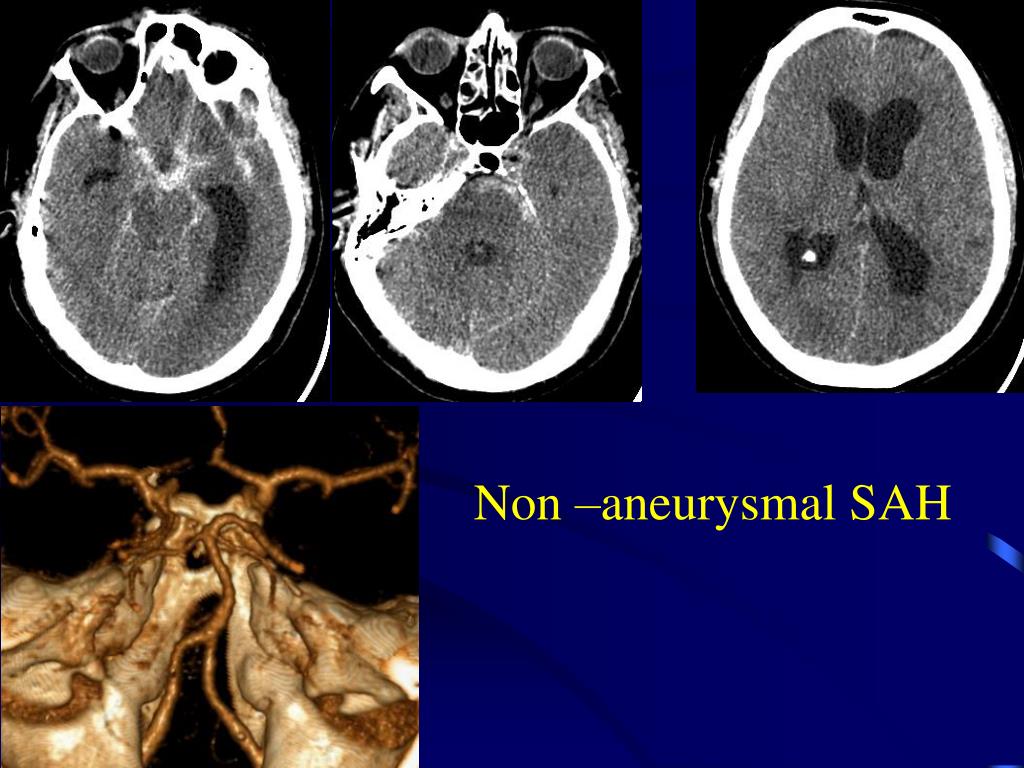 PPT - Subarachnoid Haemorrhage When to screen? Whom to treat ...