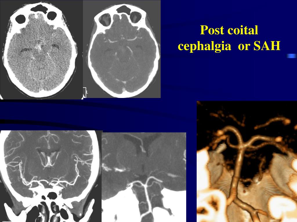 PPT - Subarachnoid Haemorrhage When to screen? Whom to treat ...