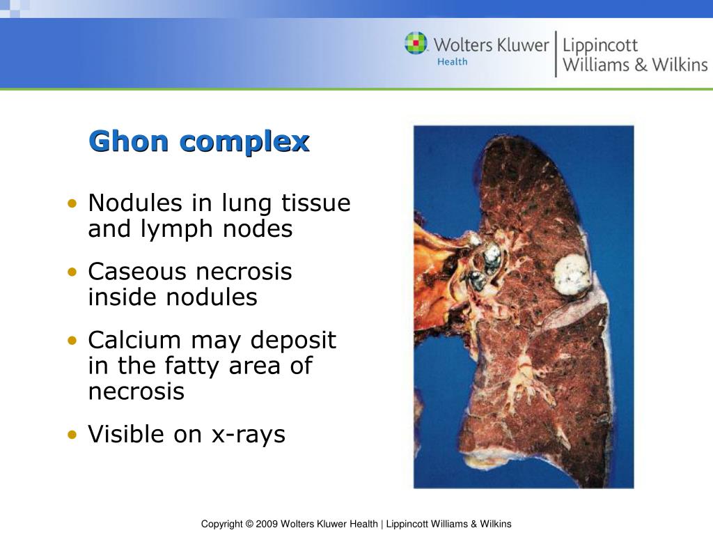 PPT - Chapter 21 Respiratory Tract Infections, Neoplasia, and Childhood ...