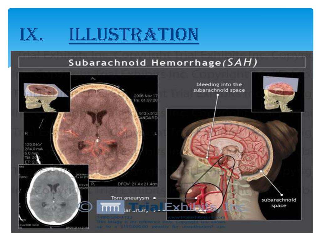 Ppt Subarachnoid Hemorrhage Powerpoint Presentation Id 2959092 239