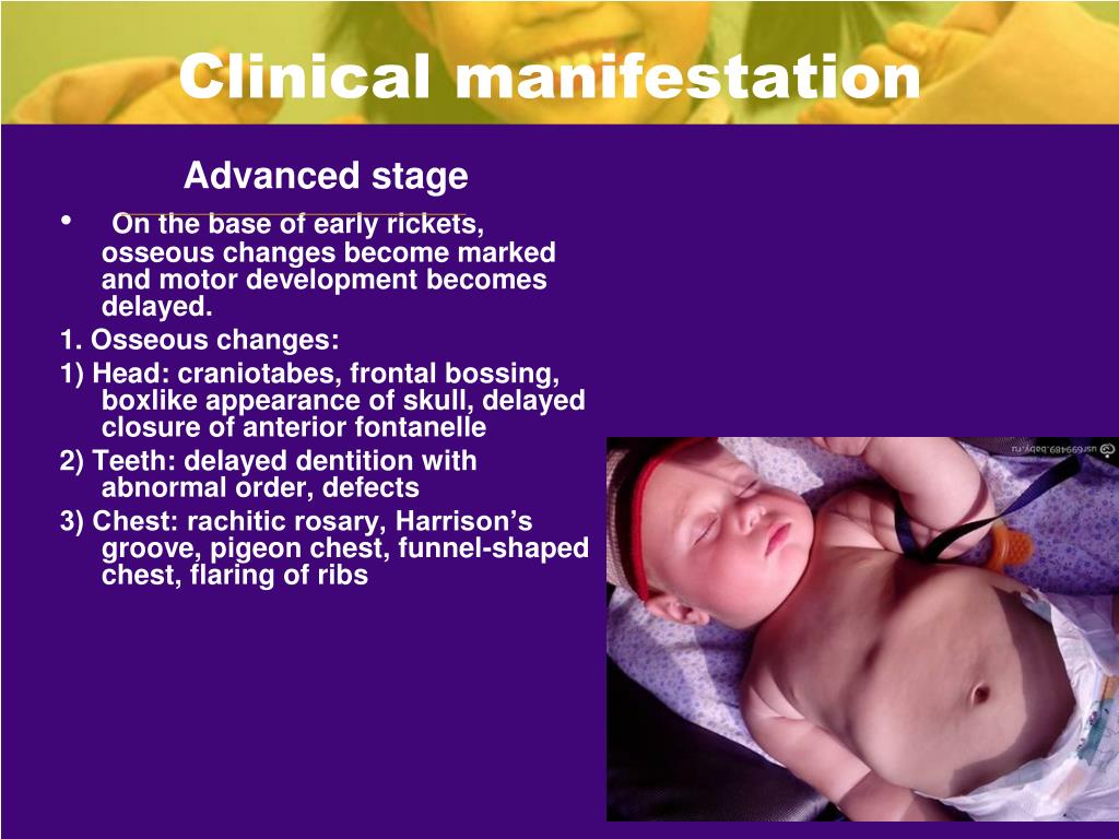 PPT - Rickets: Etiology, pathogenesis, clinical features, diagnostics ...