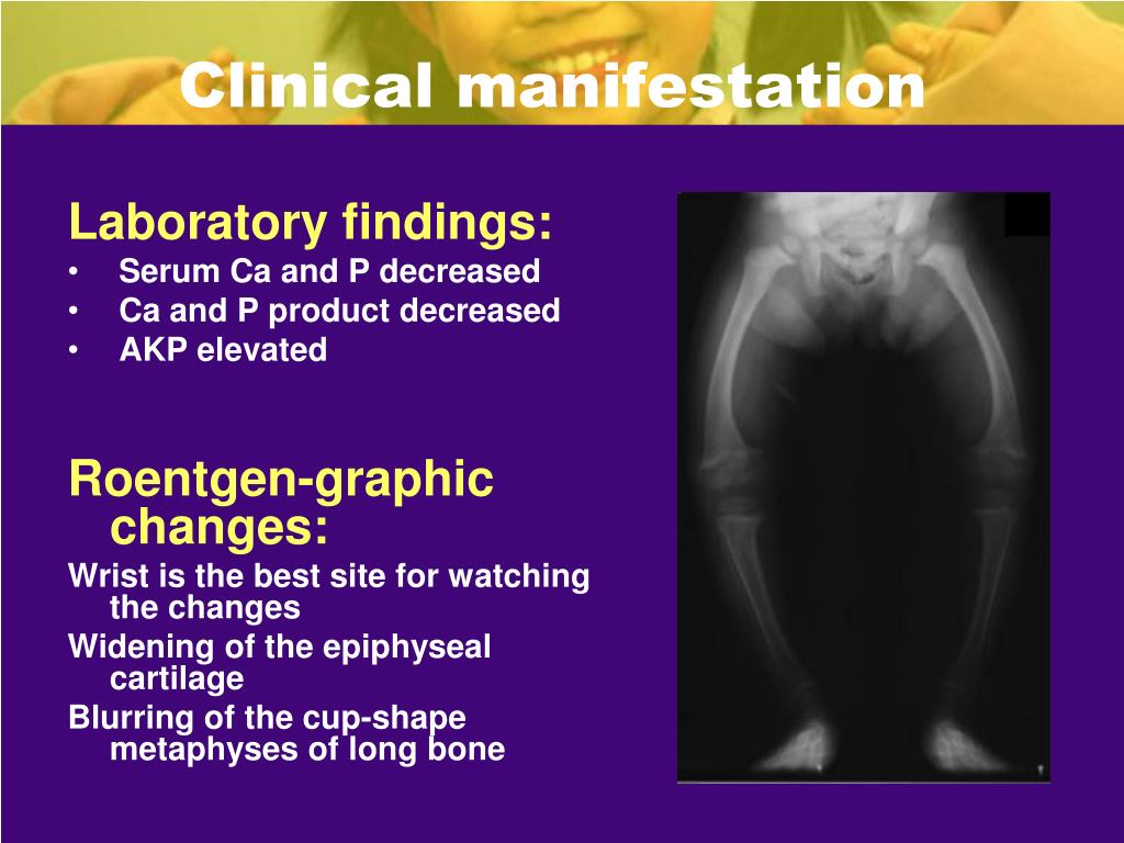 PPT - Rickets: Etiology, pathogenesis, clinical features, diagnostics ...