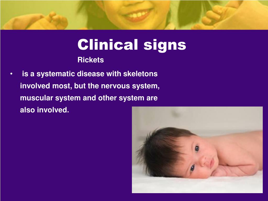 PPT - Rickets: Etiology, pathogenesis, clinical features, diagnostics ...
