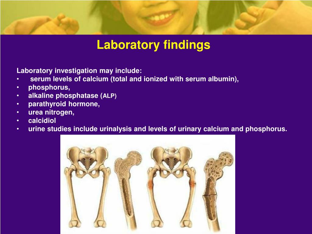 PPT - Rickets: Etiology, pathogenesis, clinical features, diagnostics ...