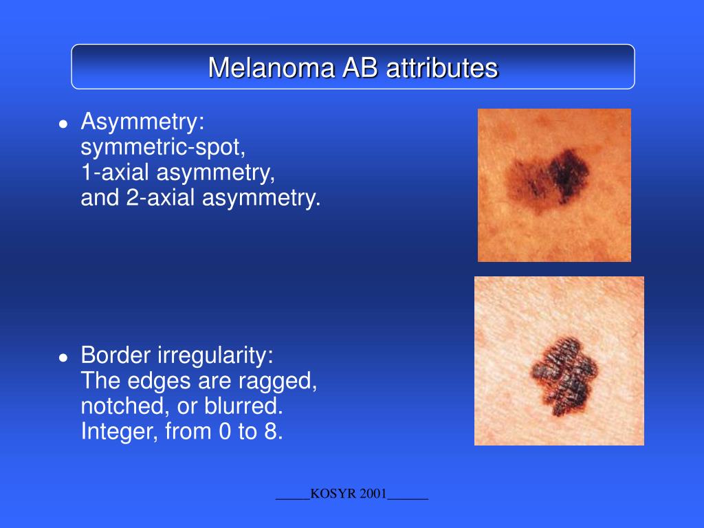 PPT - Rules for Melanoma Skin Cancer Diagnosis PowerPoint Presentation ...