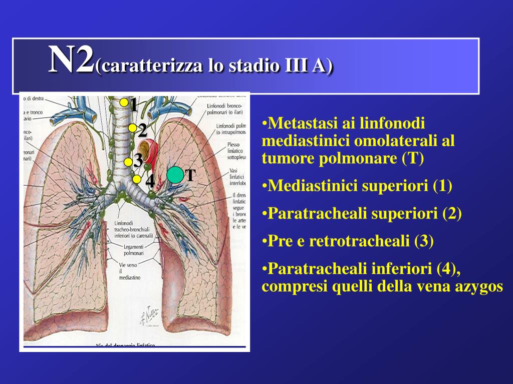 Linfonodi Mediastinici Linfonodi Reattivi