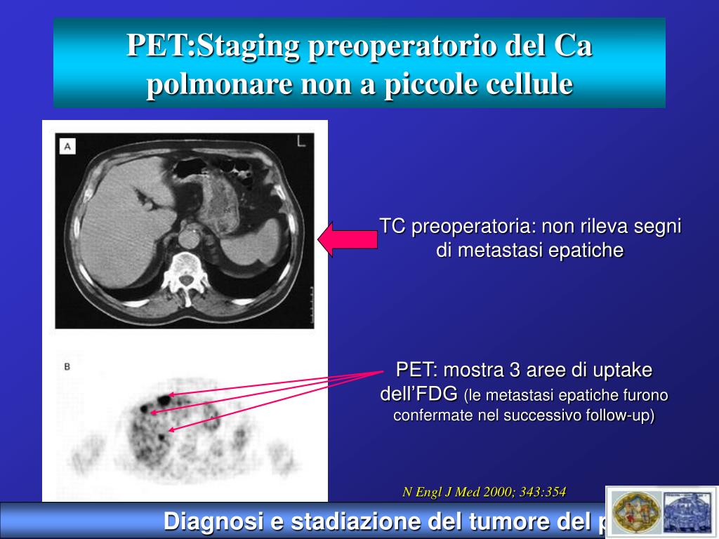 PPT - DIAGNOSI E STADIAZIONE DEL TUMORE POLMONARE PowerPoint ...