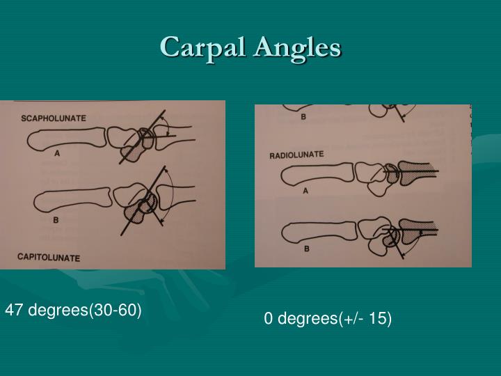 PPT - KIENBOCK’S DISEASE PowerPoint Presentation - ID:3376665