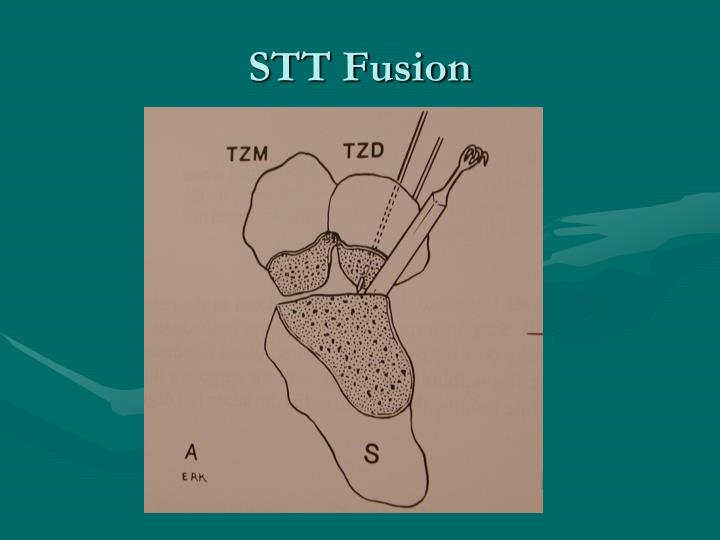 PPT - KIENBOCK’S DISEASE PowerPoint Presentation - ID:3376665