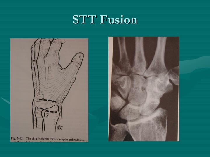 PPT - KIENBOCK’S DISEASE PowerPoint Presentation - ID:3376665