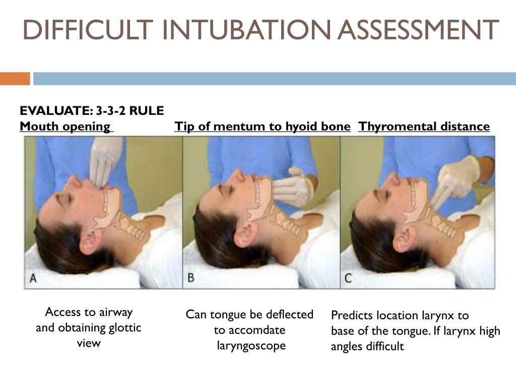 PPT - THE DIFFICULT AIRWAY MANAGEMENT IN ADULT CRITICAL CARE PowerPoint ... PPT - THE DIFFICULT AIRWAY MANAGEMENT IN ADULT CRITICAL CARE PowerPoint ...