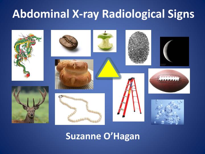 PPT - Abdominal X-ray Radiological Signs PowerPoint Presentation, free ...
