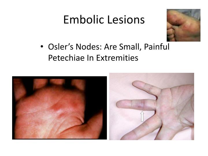 PPT - Infective Endocarditis PowerPoint Presentation - ID:3377701