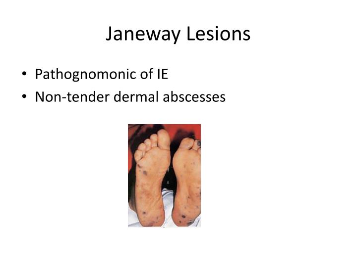 PPT - Infective Endocarditis PowerPoint Presentation - ID:3377701