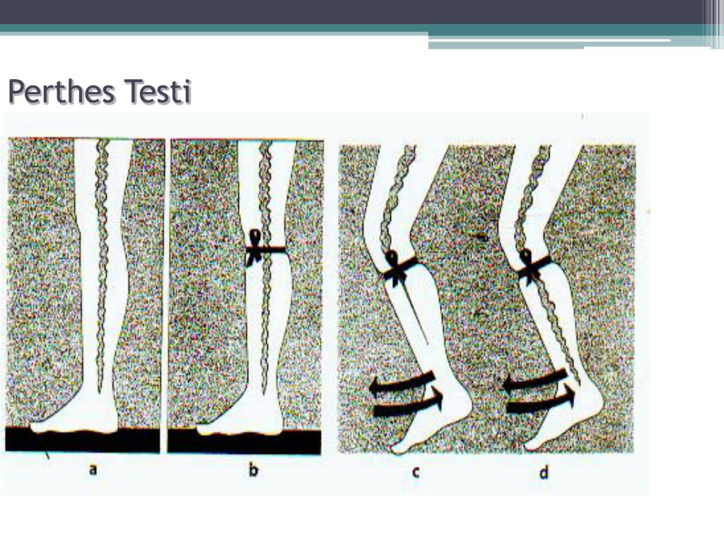 PPT - KRONİK VENÖZ YETMEZLİK VE TEDAVİSİ PowerPoint Presentation, free ...