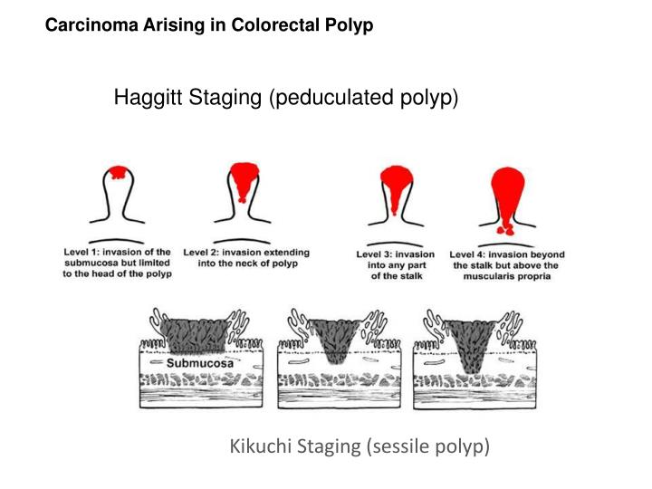 PPT - Multistep Progression of Neoplasia PowerPoint Presentation - ID ...