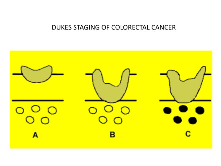 PPT - Multistep Progression of Neoplasia PowerPoint Presentation - ID ...