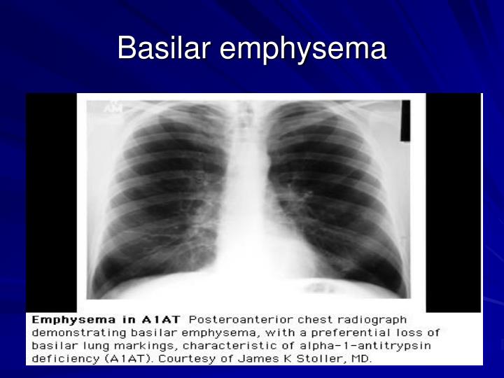 PPT - Evaluation of abnormal liver associated enzymes PowerPoint ...