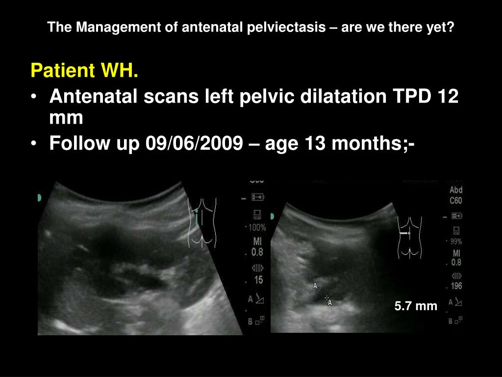 PPT - The Management of antenatal pelviectasis – are we there yet ...