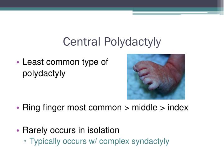 PPT - Polydactyly PowerPoint Presentation - ID:3383975