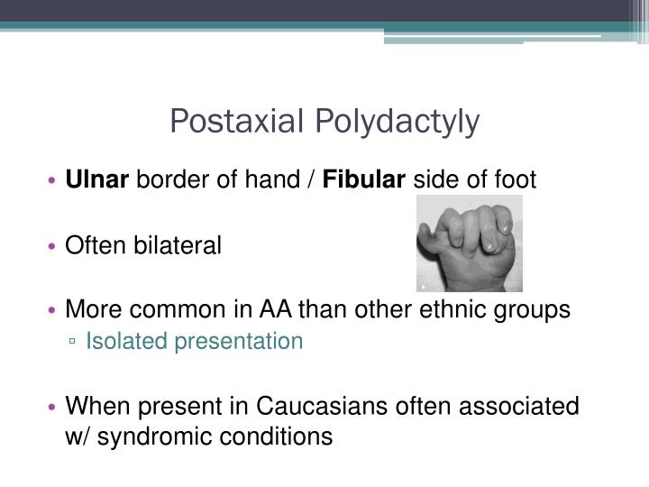 PPT - Polydactyly PowerPoint Presentation - ID:3383975