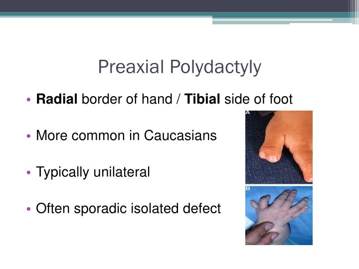 PPT - Polydactyly PowerPoint Presentation - ID:3383975