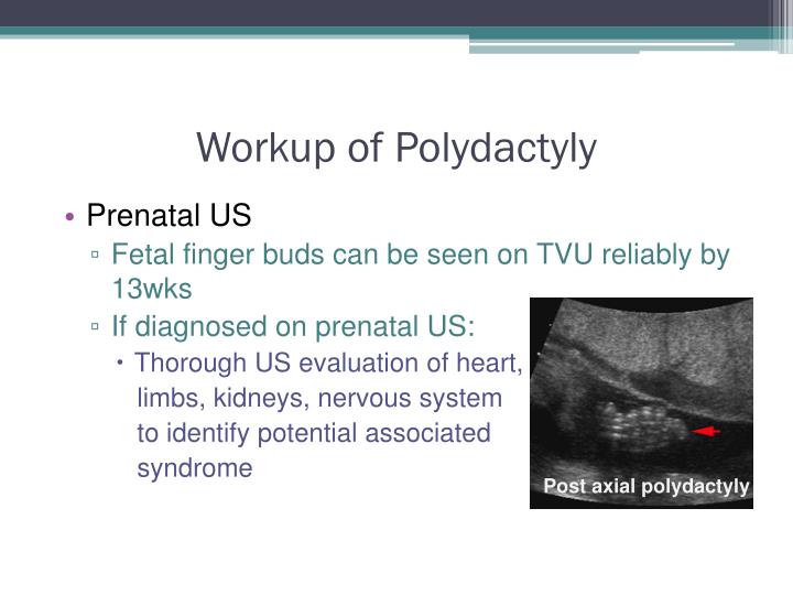 PPT - Polydactyly PowerPoint Presentation - ID:3383975
