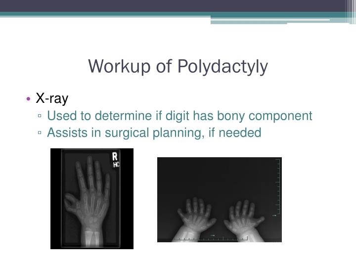 PPT - Polydactyly PowerPoint Presentation - ID:3383975