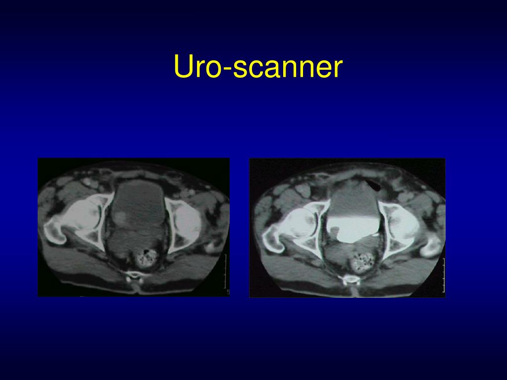 PPT - Hématurie d’origine urologique PowerPoint Presentation, free ...