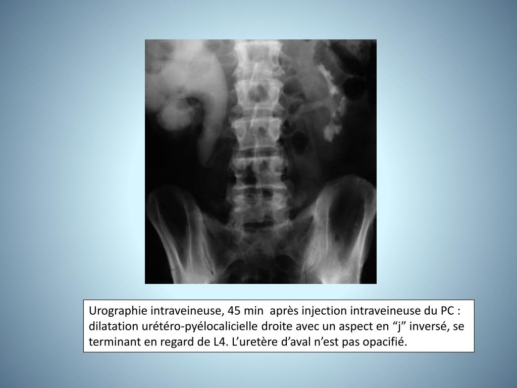PPT - URETERE RETROCAVE : A PROPOS DE DEUX CAS CLINIQUES PowerPoint ...