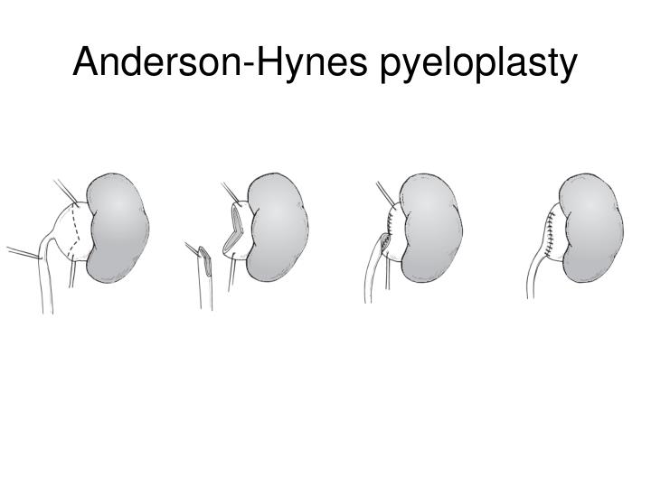 PPT - Hydronephrosis PowerPoint Presentation - ID:3387739