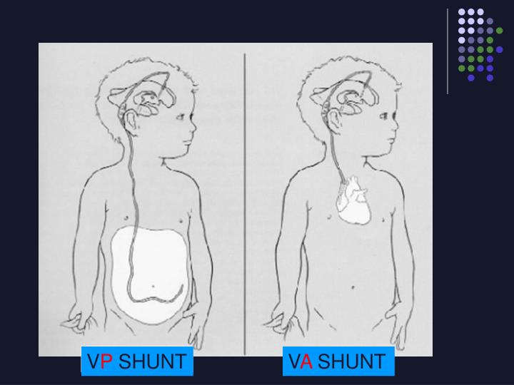 PPT - VP Shunts PowerPoint Presentation - ID:3387790