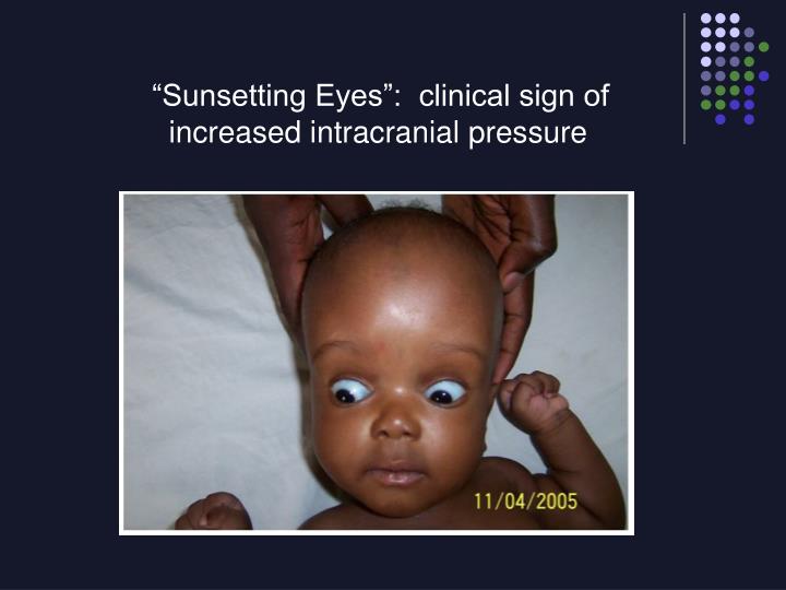 PPT - VP Shunts PowerPoint Presentation - ID:3387790