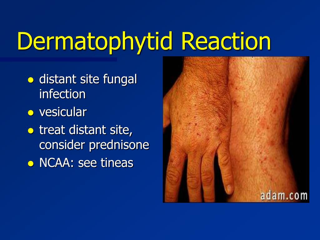 PPT - Sports Dermatology PowerPoint Presentation, free download - ID ...