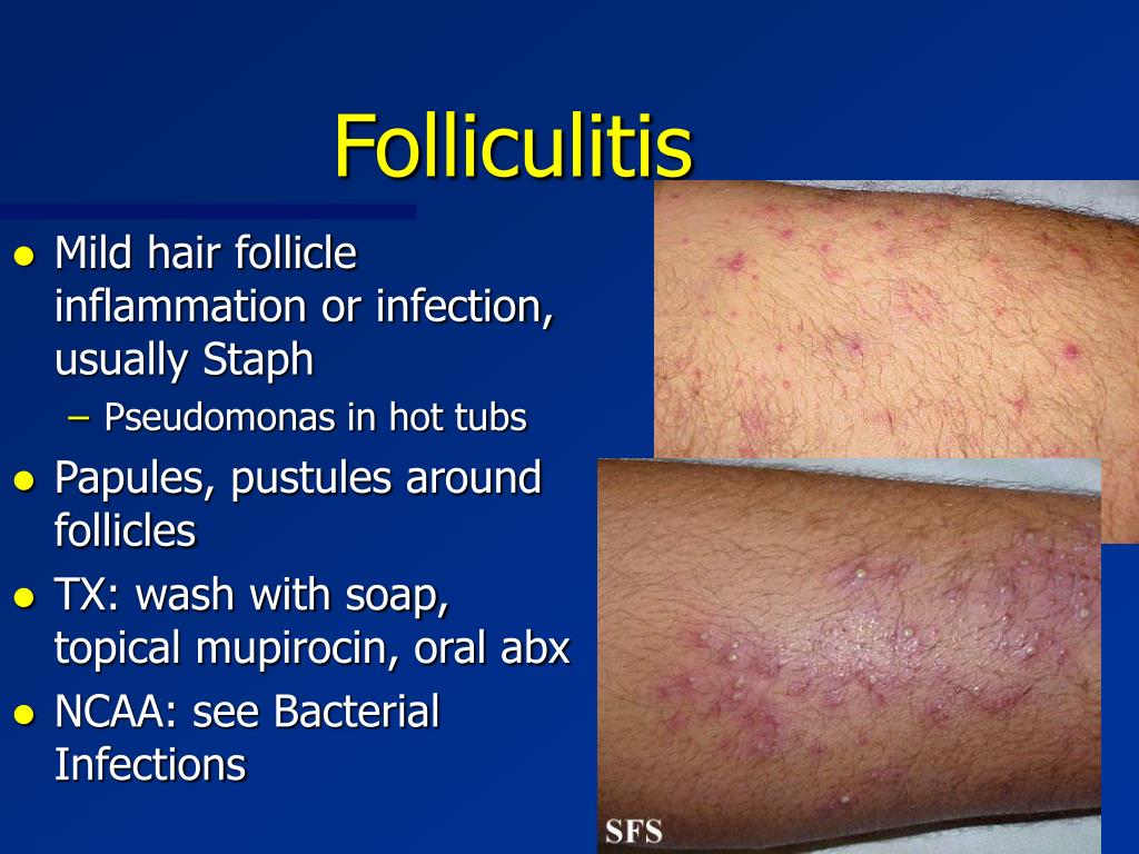 PPT - Sports Dermatology PowerPoint Presentation, free download - ID ...