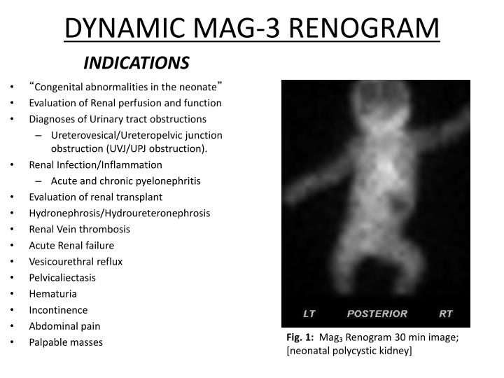 PPT - Crossed-Fused Renal Ectopia imaged with Tc99m-MAG₃ PowerPoint ...
