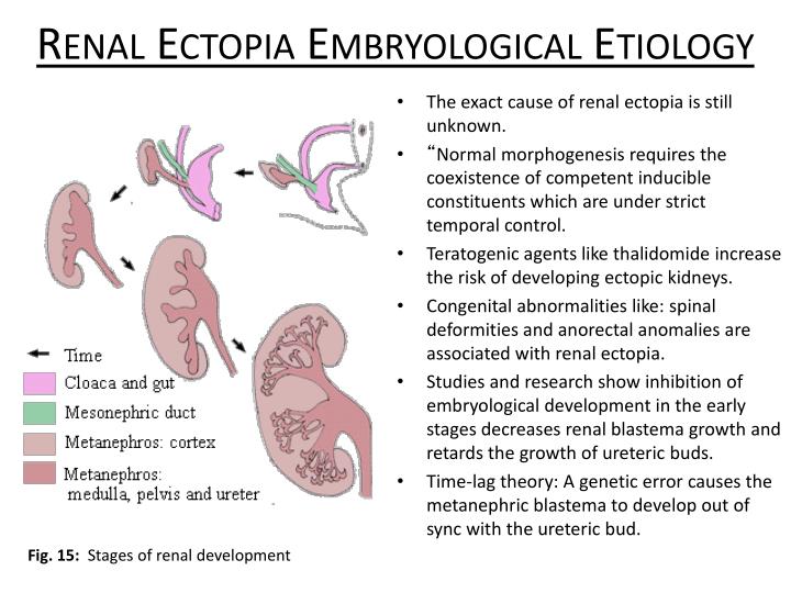 PPT - Crossed-Fused Renal Ectopia imaged with Tc99m-MAG₃ PowerPoint ...
