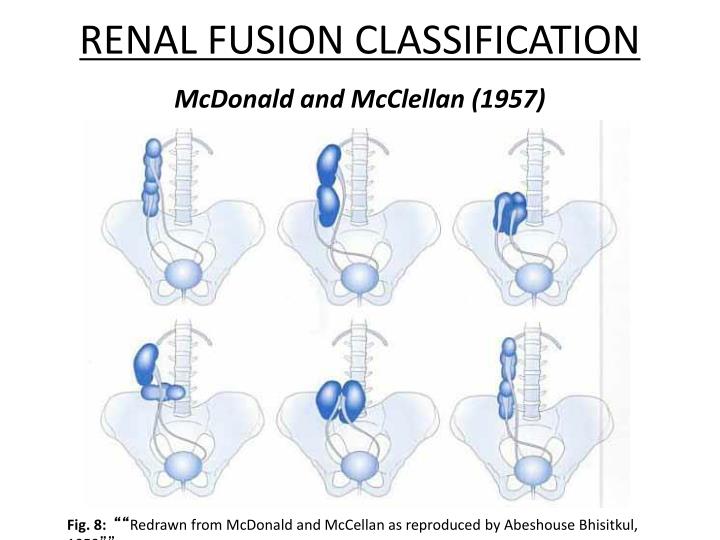 PPT - Crossed-Fused Renal Ectopia imaged with Tc99m-MAG₃ PowerPoint ...