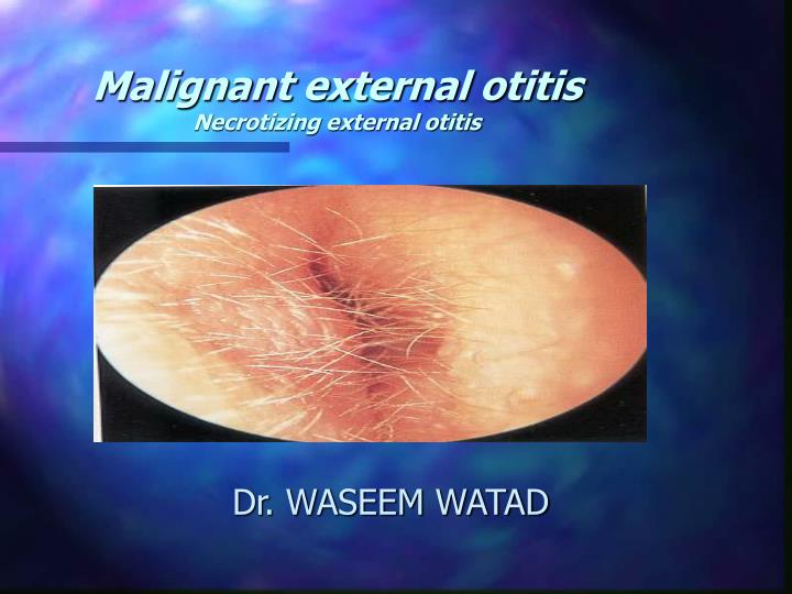 PPT - Malignant external otitis Necrotizing external otitis PowerPoint ...
